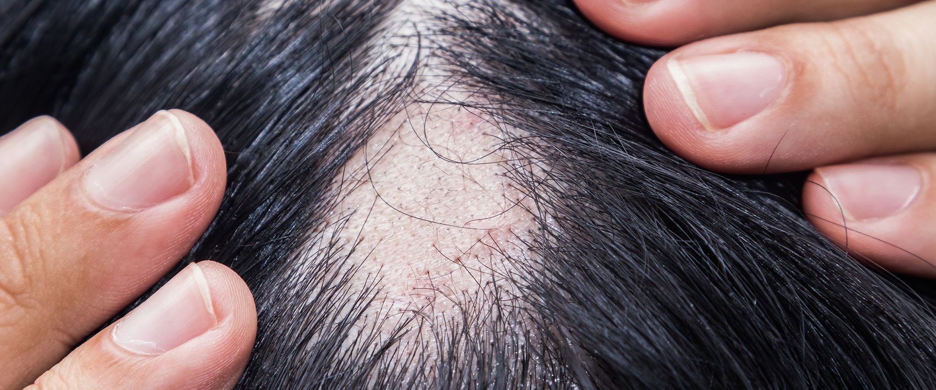 Understanding the Link Between Iron-Deficiency Anemia and Hair Loss