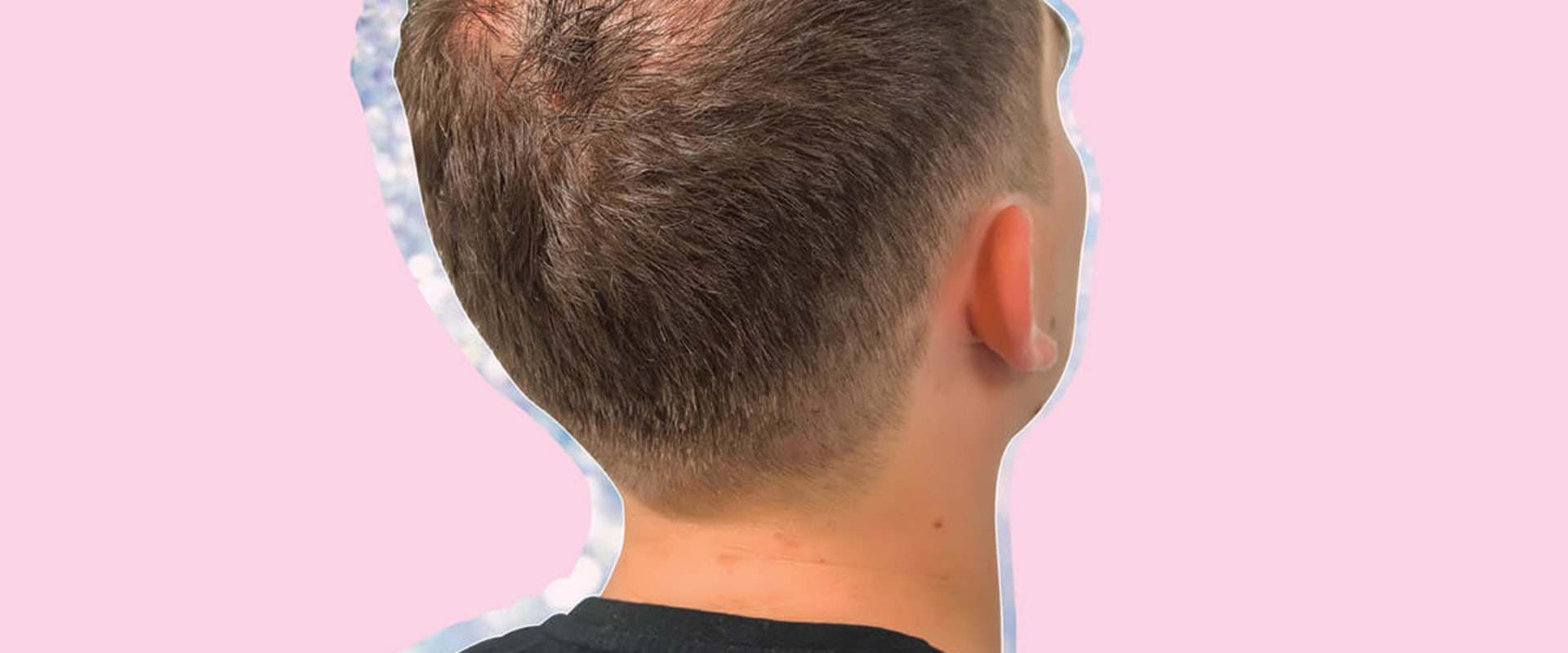 Understanding Male Pattern Baldness: Causes, Genetics, and Tips for ...